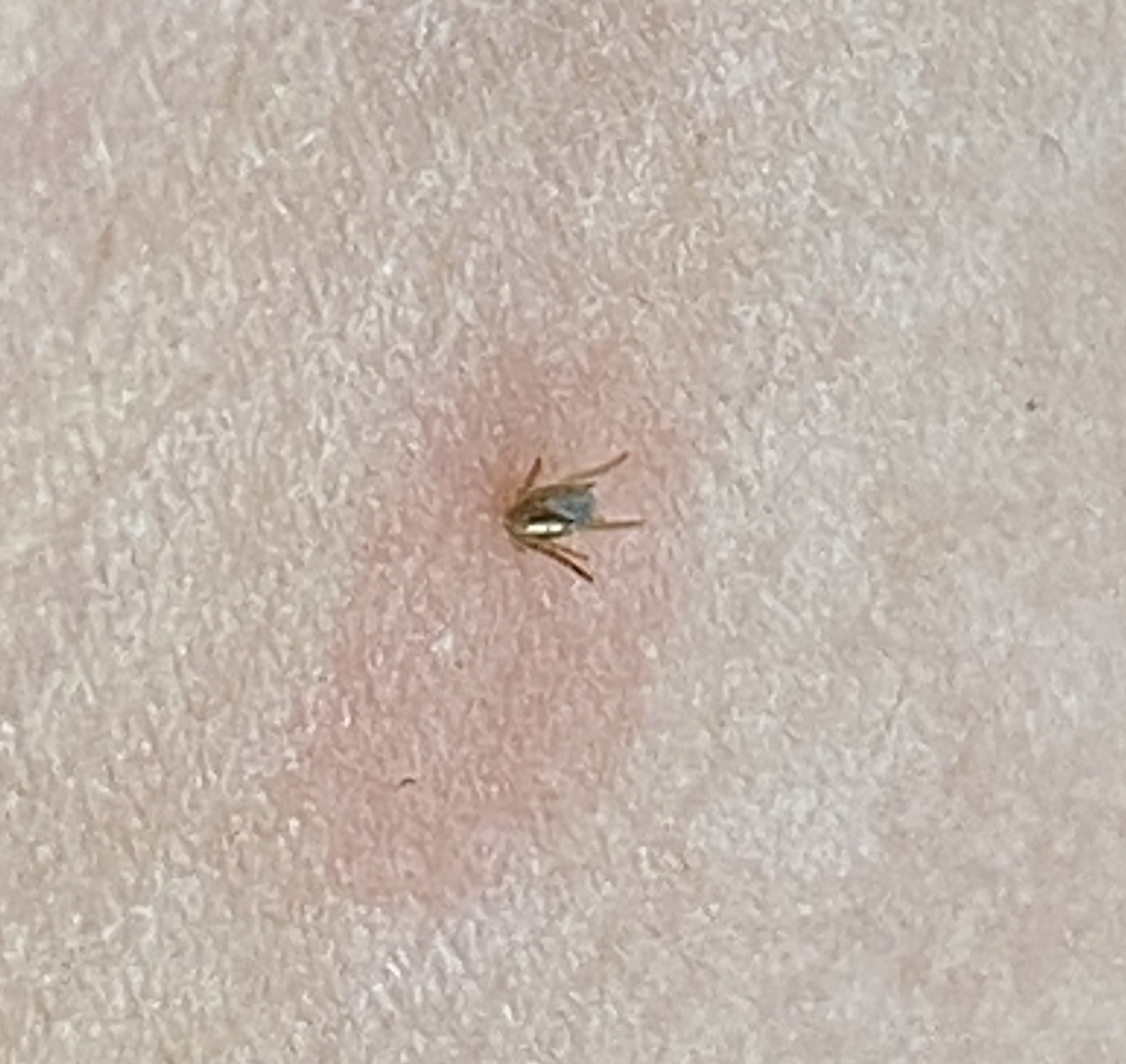 Tick allergy - Allergy & Anaphylaxis Australia